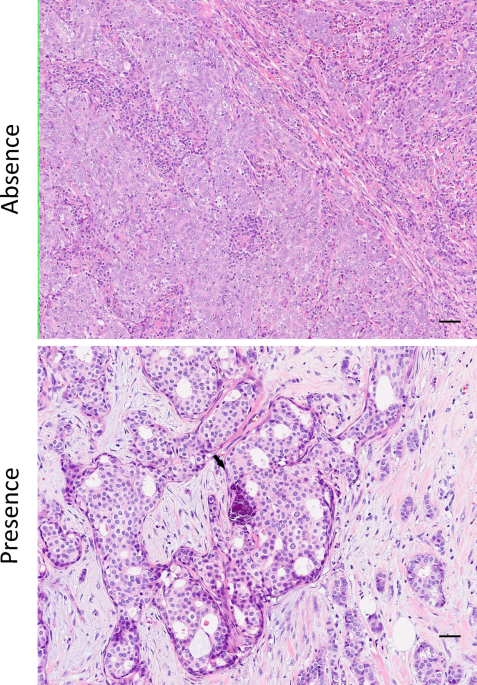 Breast microcalcifications as indicators of bone metastasis risk in ...