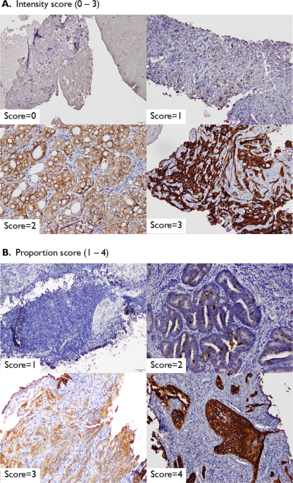 Prognostic relevance of TROP2 expression in patients with non-small cell lung cancer receiving ...