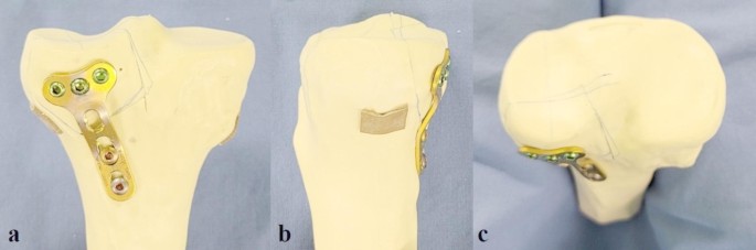 Biomechanical comparison between rim plating and posterior buttress ...