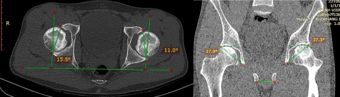 Anatomical alignment of the acetabular component using transverse ...