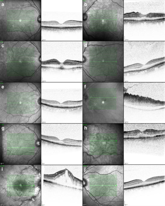 Manual measurement of SD-OCT images of hyperreflective retinal layers ...