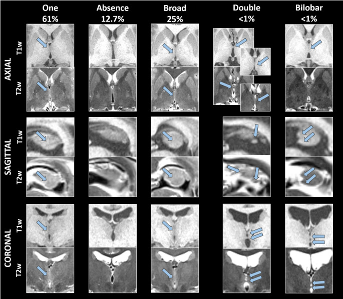 Cognitive, neuroimaging, and genetic insights on the interthalamic ...