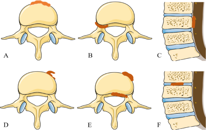 Risk factors for refracture by different cement leakage after ...