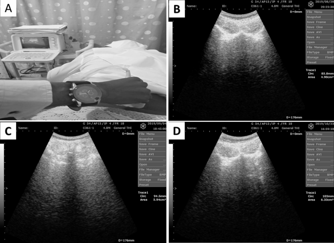 Lumbar stabilization exercise with and without real-time ultrasound imaging biofeedback in ...