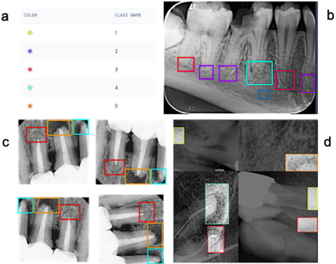 Automated assessment of periapical health based on the radiographic ...