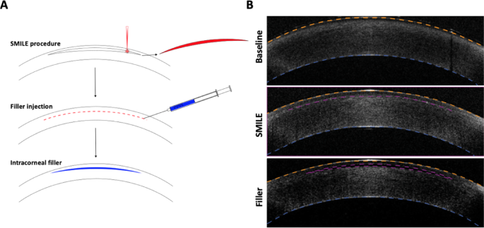 Ex vivo evaluation of corneal filler injection for enhancement after ...