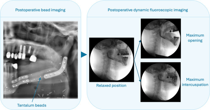 First-in-human application of dynamic fluoroscopic analysis to quantify ...