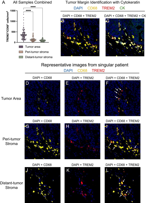 TREM2 expressing macrophages are not associated with prognostic markers ...