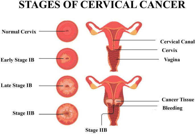 Explainable AI based cervical cancer prediction using FSAE feature ...