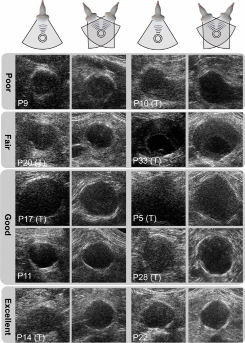 Strain imaging in abdominal aortic aneurysms using bistatic dual ...