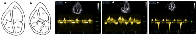 Echocardiographic assessment of apical morphology and dynamics in ...