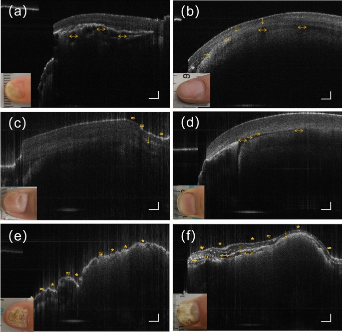 Quantitative analysis of psoriatic nail disease using optical coherence ...