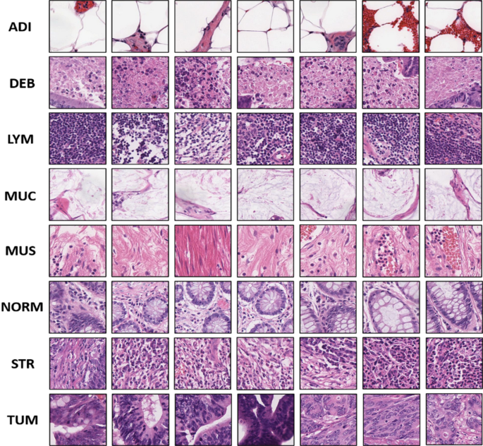 Automated tumor stroma ratio assessment in colorectal cancer using ...