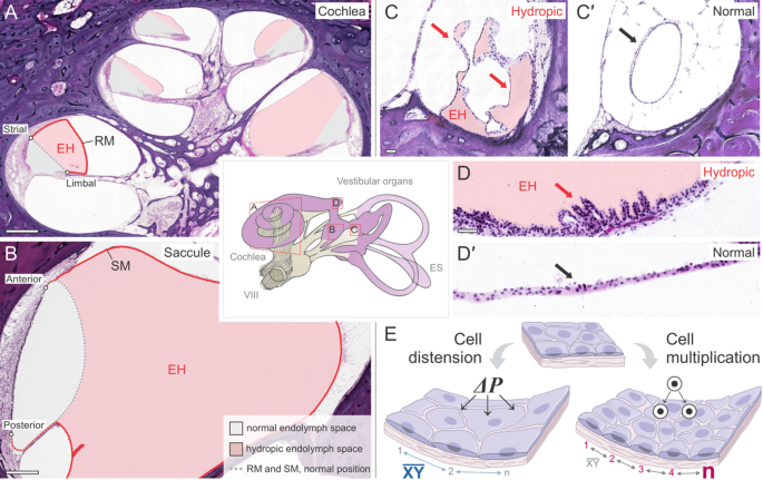 Hyperplastic growth, not hydrostatic distension, in endolymphatic ...