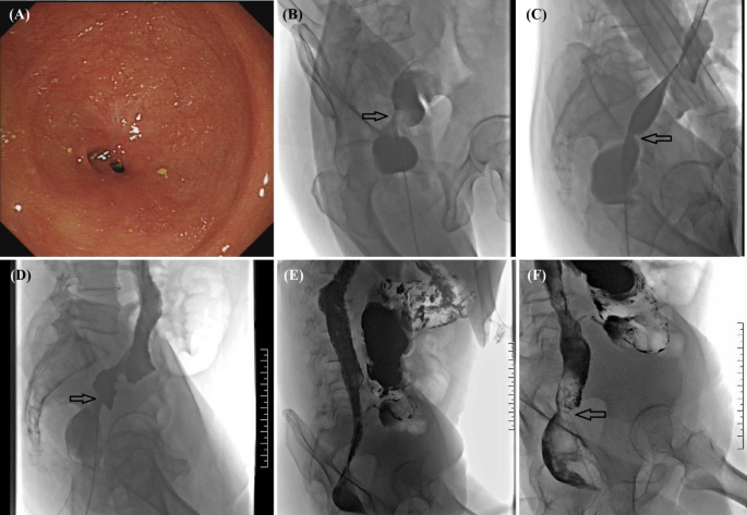 A comparative study of small and large balloon dilation for the ...