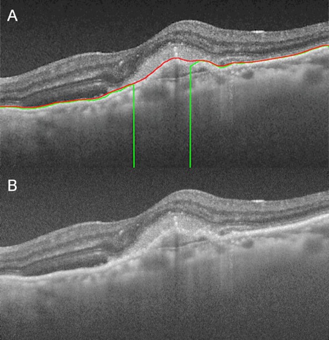 Evaluation of deep learning-based retinal pigment epithelium ...