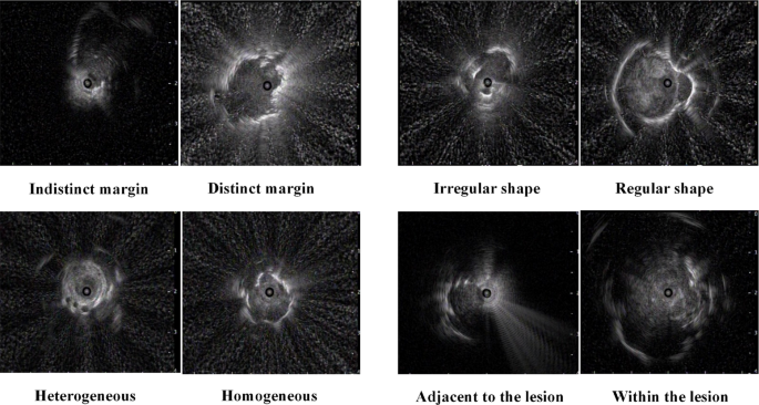 A predictive model for diagnosing peripheral pulmonary lesions using ...