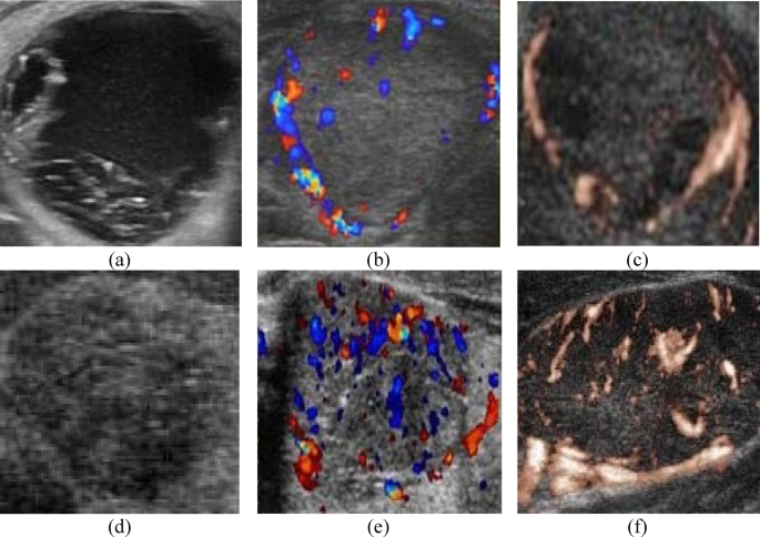 Enhancing automatic diagnosis of thyroid nodules from ultrasound scans ...