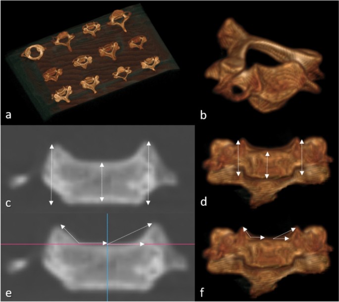 Three dimensional morphometric analysis of cervical uncinate process ...