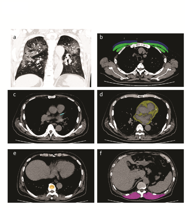 CT-based phenotyping of COVID-19: cluster analysis of pulmonary and ...
