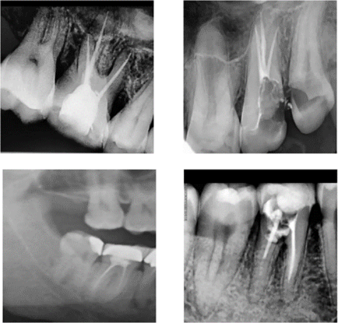 AI meets endodontics a deep learning approach to precision diagnosis ...