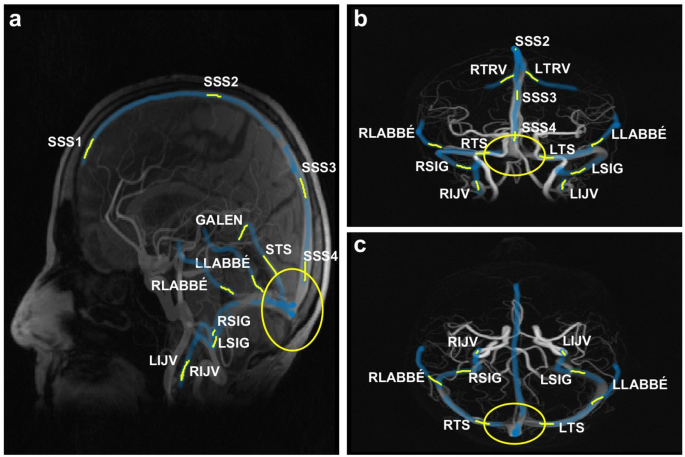 Arterial-optimized 4D-flow MRI for quantifying flow and pulsatility in ...