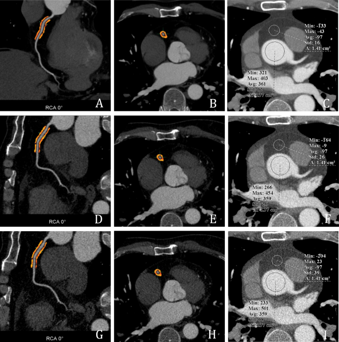 Differences in different reconstruction algorithms for coronary CTA ...