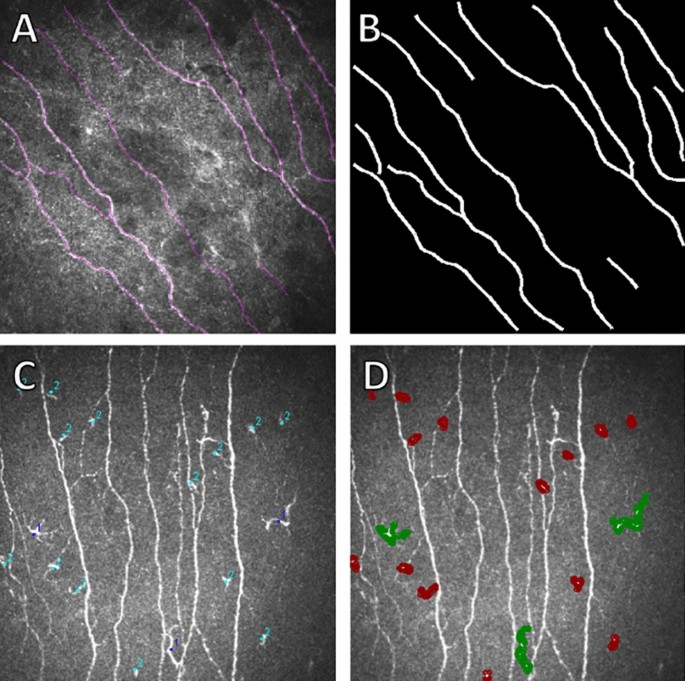Deep learning-based segmentation and density estimation of corneal ...