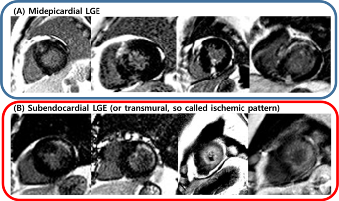 Effects of genetic mutations on left ventricular myocardial mechanics ...