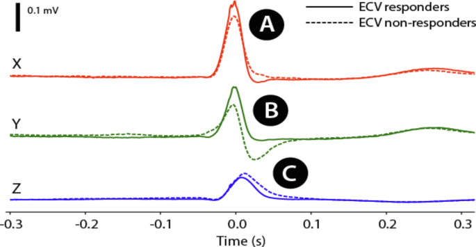 Automatically optimized vectorcardiographic features are associated ...