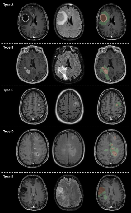 Implication of tumor morphology and MRI characteristics on the accuracy ...