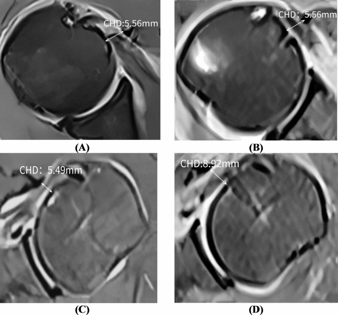 Analysis of the therapeutic efficacy of arthroscopic repair of the ...