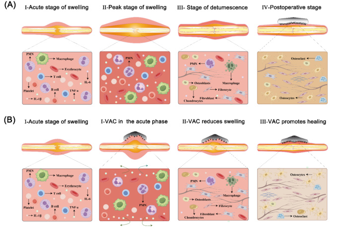 A novel approach for managing the incisions of tibial plateau fractures ...