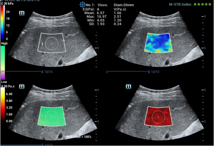 Assessment of liver involvement in Wilson’s disease with different ...