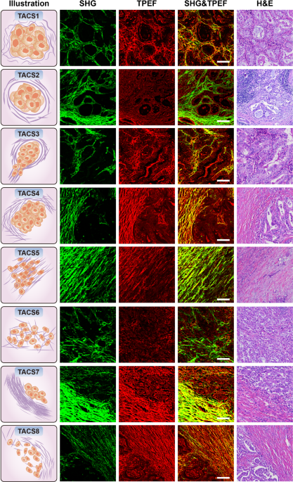 Multiphoton imaging-based quantifiable collagen signatures for ...