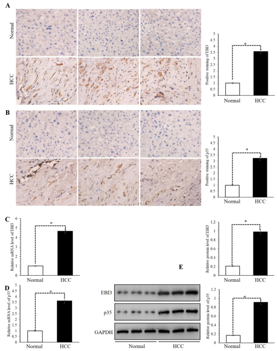 IL35 modulates HBV-related HCC progression via IL6-STAT3 signaling ...