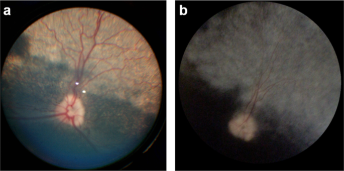 GTPBP2 in-frame deletion in canine model with non-syndromic progressive ...