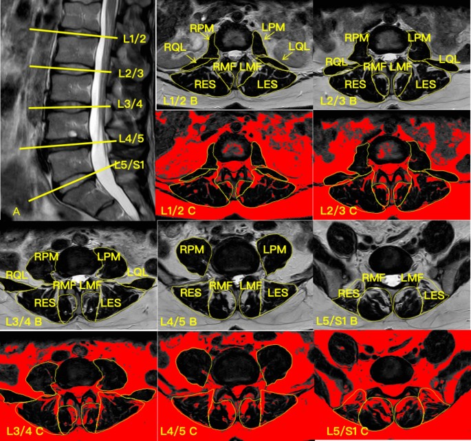 Sex-specific asymmetry in lumbar paraspinal muscles among chronic low ...