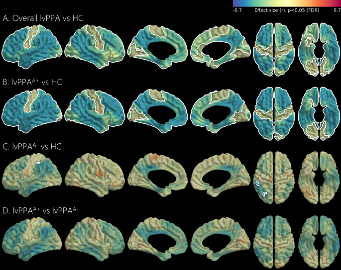 Brain Perfusion, Atrophy, and Dopaminergic Changes in Amyloid Negative ...