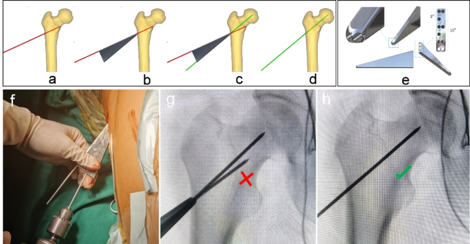 Core decompression assisted by multi-functional minimally invasive ...