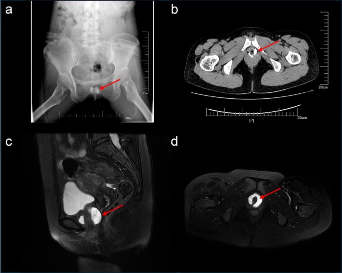 Experience in conversion of symptomatic urethral diverticulum to ...