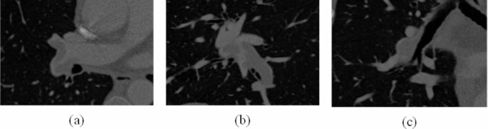 Detection and segmentation of pulmonary embolism in 3D CT pulmonary angiography using a ...