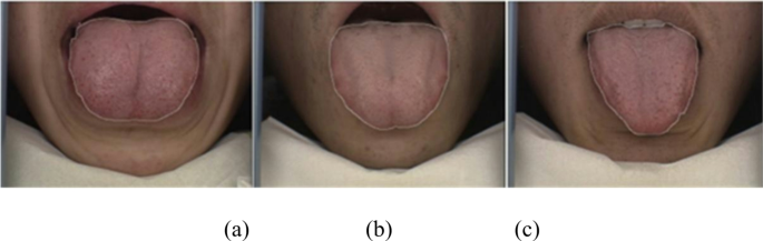 Tongue shape classification based on IF-RCNet | Scientific Reports