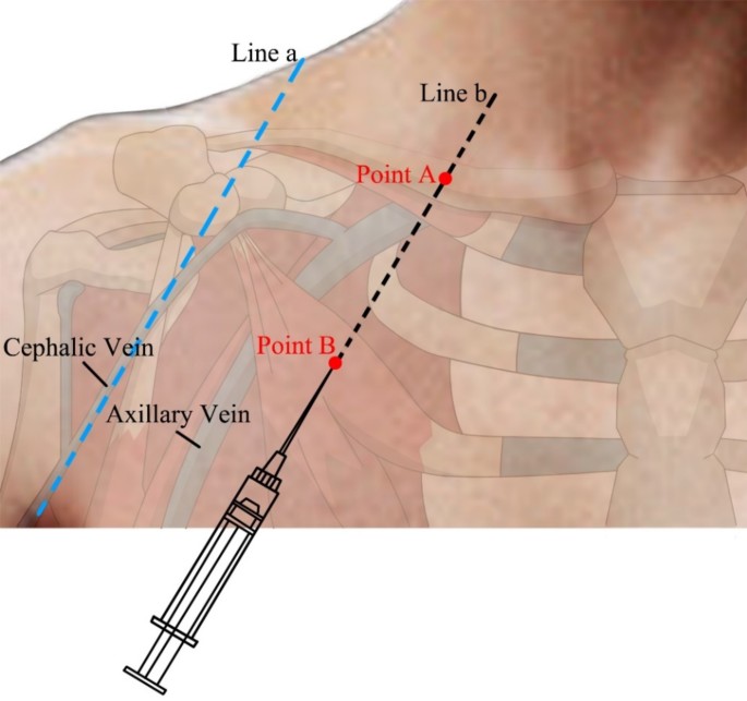 Clinical efficacy and safety of a new single-incision axillary vein ...