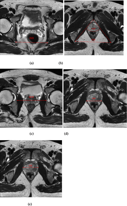 Preoperative magnetic resonance imaging pelvic and prostatic parameters ...