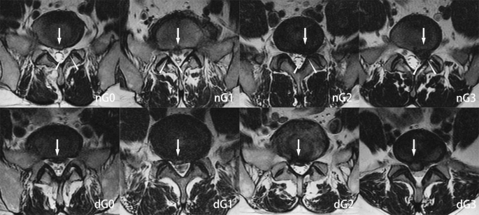 Clinical comparison of percutaneous endoscopic lumbar discectomy and ...