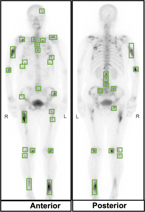 Automatic detecting multiple bone metastases in breast cancer using ...