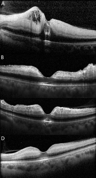 Correlation of visual acuity changes and optical coherence tomography imaging in patients with ...