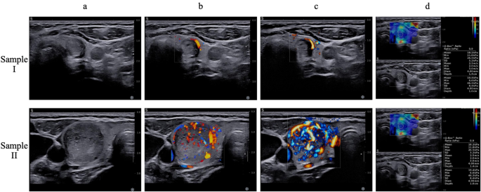 ELTIRADS framework for thyroid nodule classification integrating ...