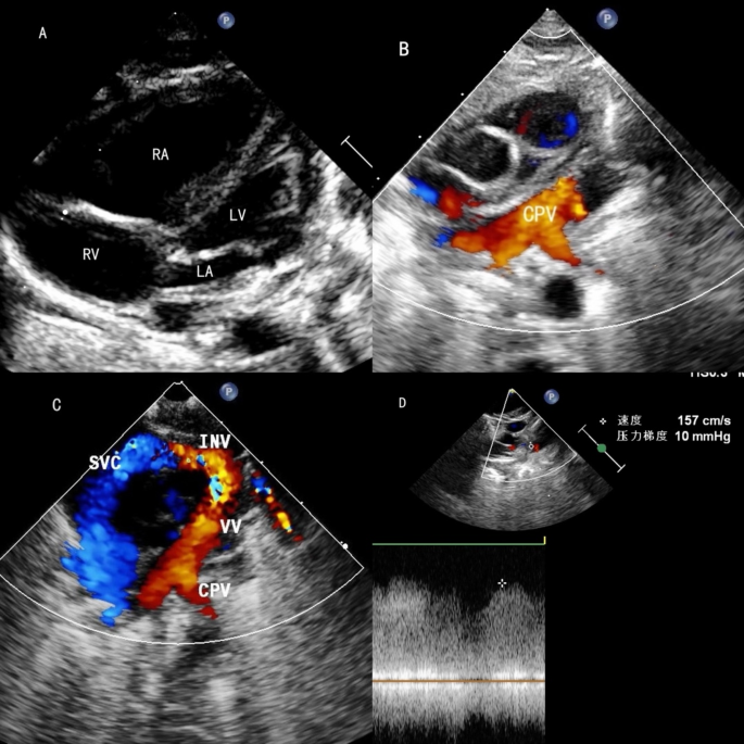 Prognostic factors in pediatrics TAPVC: a 10-year retrospective study ...
